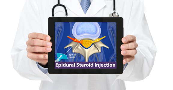 Review Shows Success of Epidural Steroid Injections for Pain Related to ...